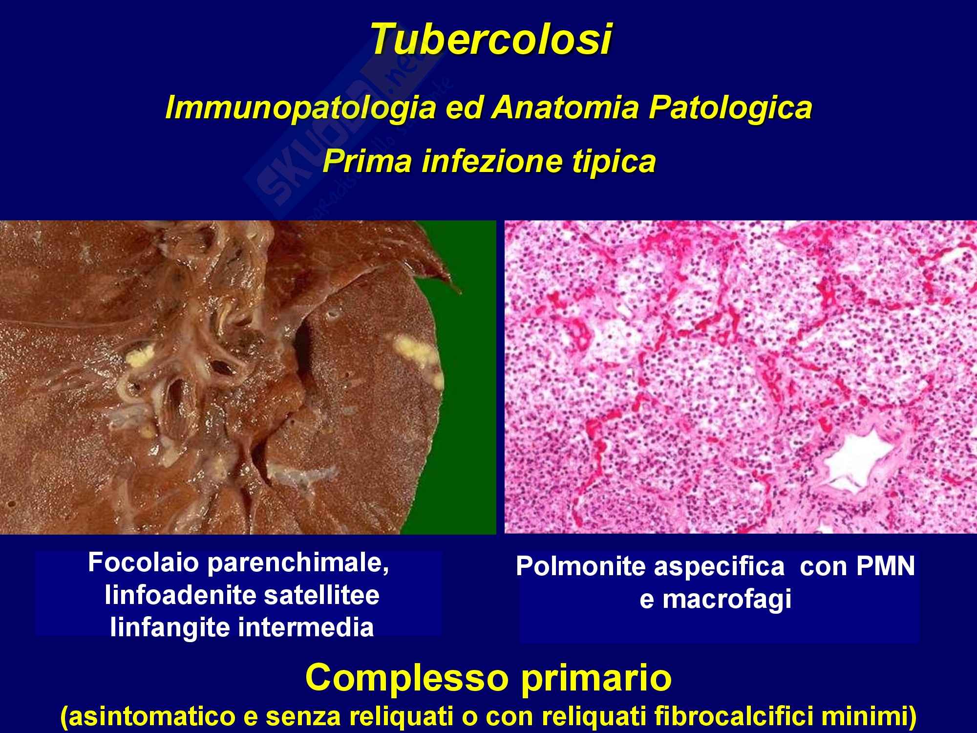TBC - Tubercolosi polmonare