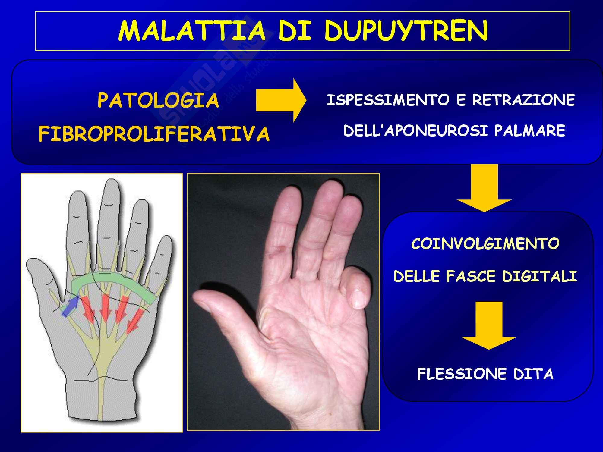 Chirurgia plastica - Malattia di Dupuytren 1