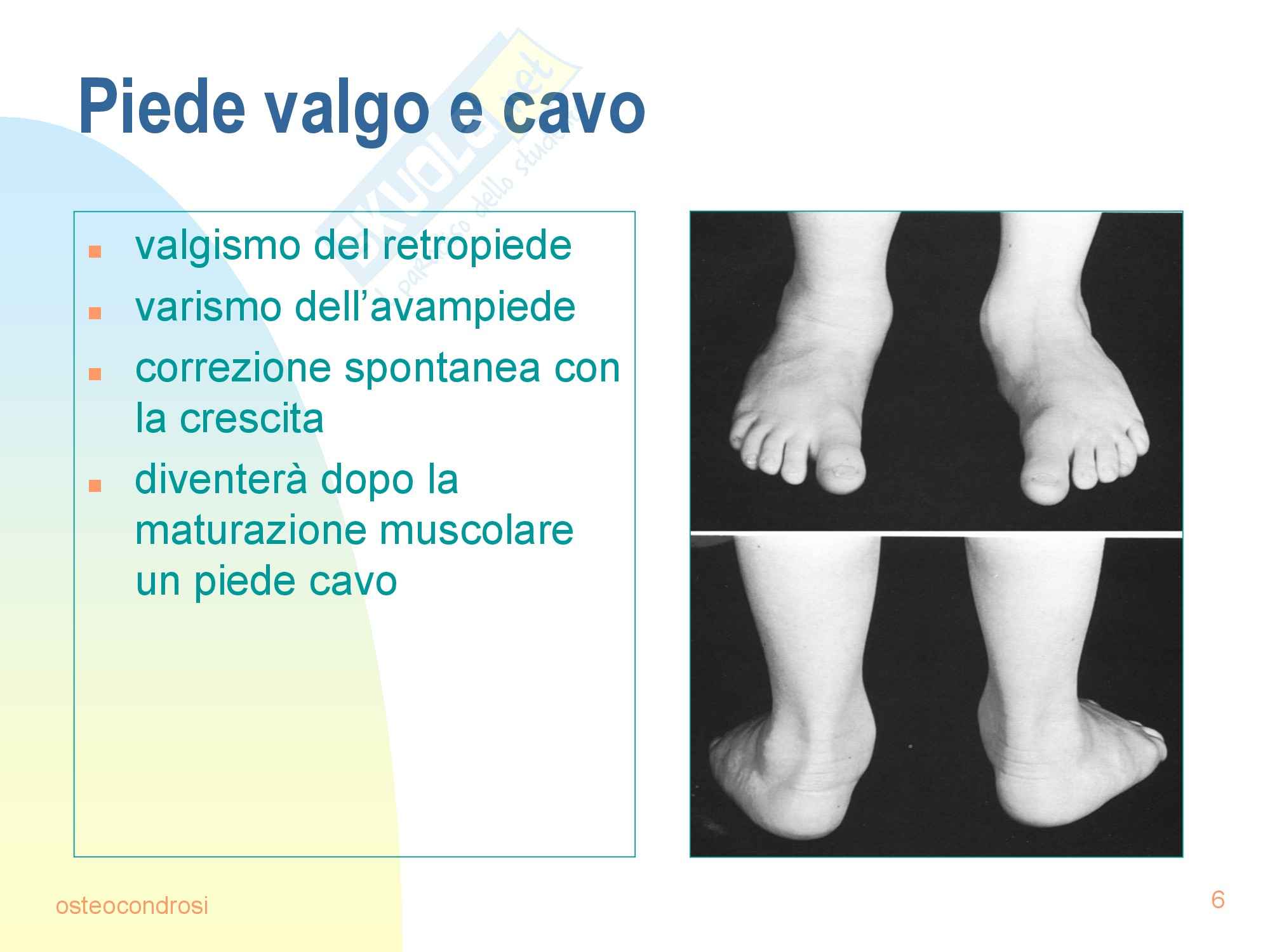 Varo e valgo - Varismo e valgismo