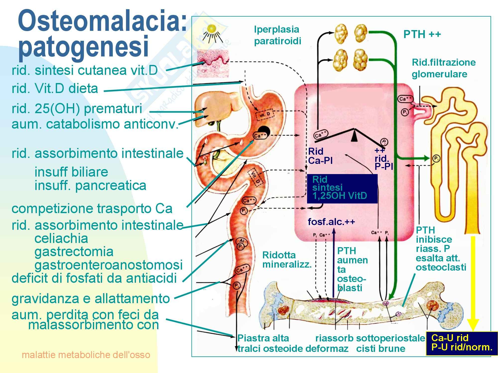 Osteomalacia